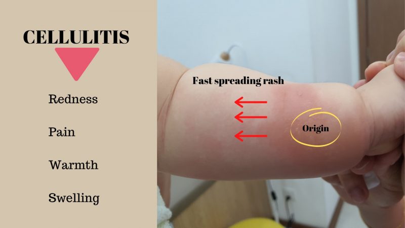 Cellulitis Skin Infection in Children – Dr Joann Child Specialist